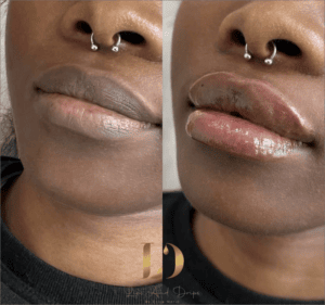 Dermal Fillers in Philadelphia, PA | Lips and Drips by Erica