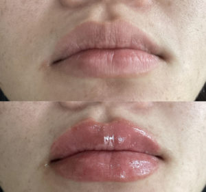 Dermal Fillers in Philadelphia, PA | Lips and Drips by Erica